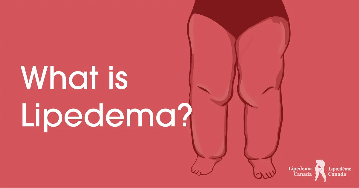 What is Lipedema: Causes, Symptoms, and Treatment | Lipedema Canada